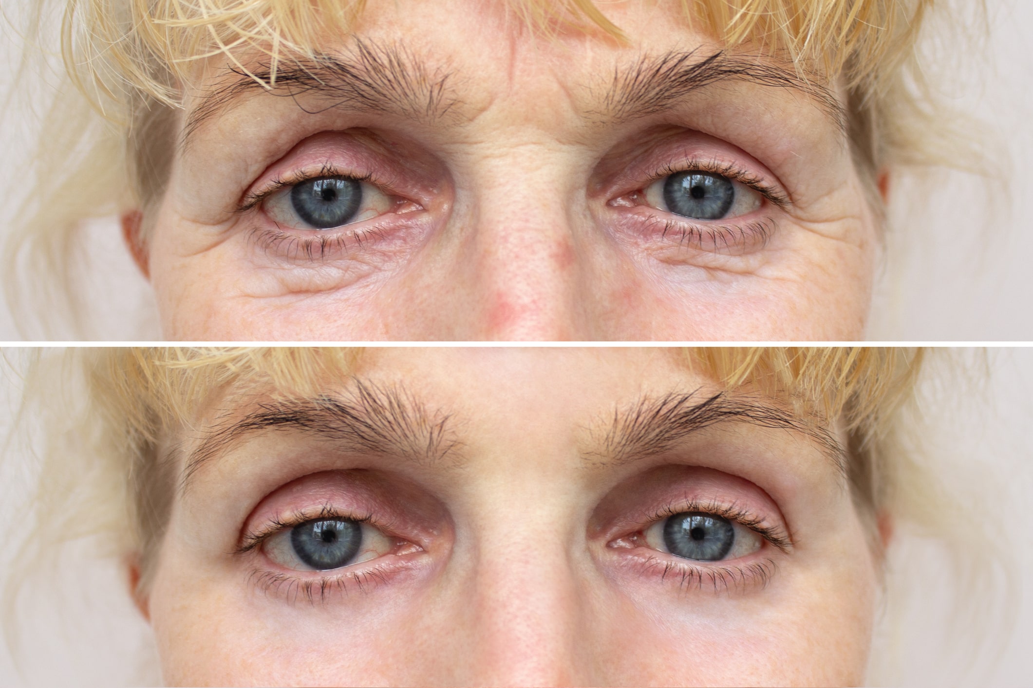Blefaroplastia LP - Hera Clinic
